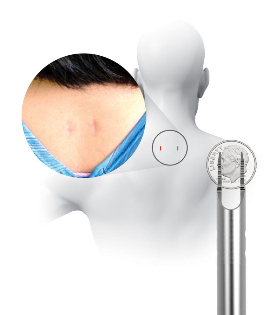 FUSE Study: Cervical Fusion Clinical Study, Baltimore MD, Dr. Omar ...