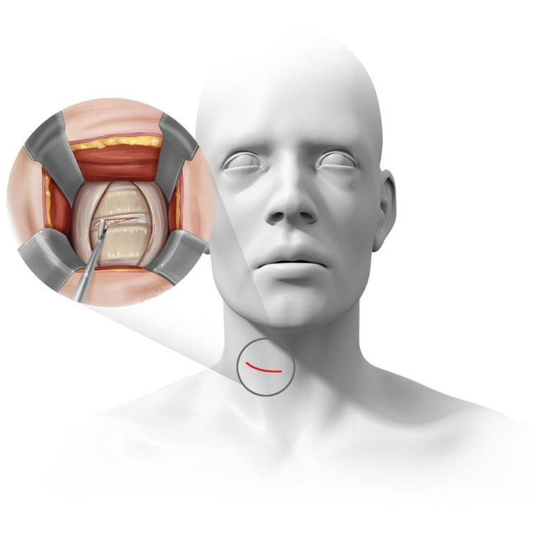 FUSE Study – IDE Clinical Study for Cervical Fusion