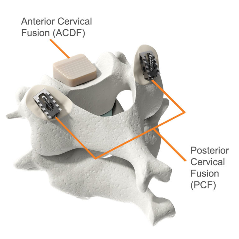 FUSE Study – IDE Clinical Study for Cervical Fusion