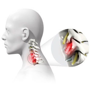 FUSE Study – IDE Clinical Study for Cervical Fusion
