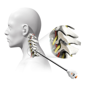 Am I Eligible? Cervical Fusion Clinical Study – MD Dr. Omar Zalatimo ...